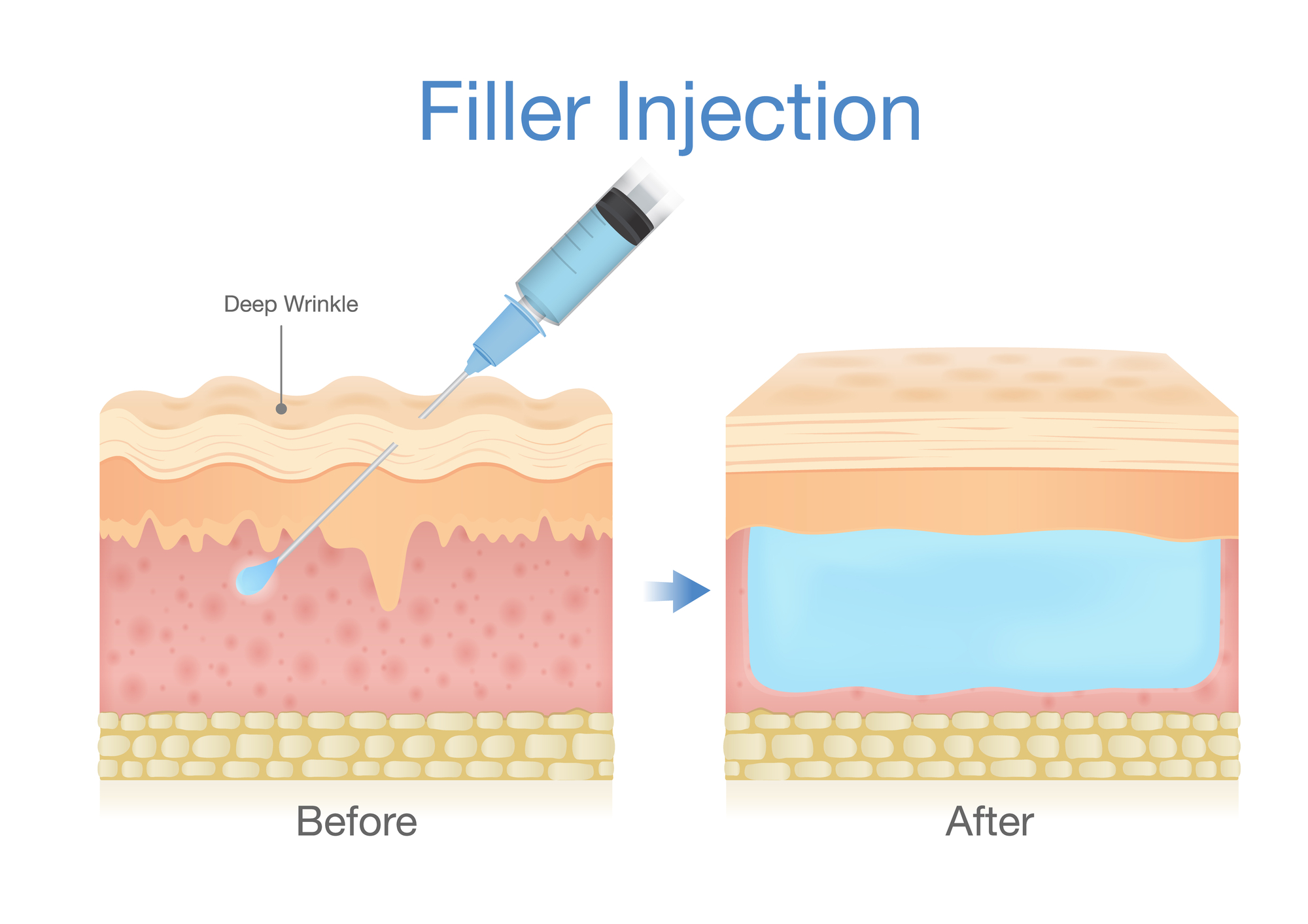 Getting to Know Injectable Dermal Fillers: What They Are and How They ...